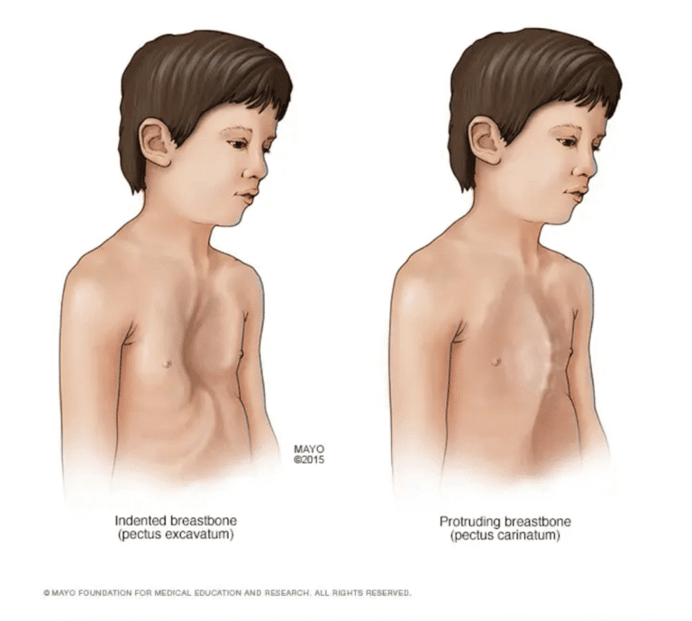 Deformidades no Tórax – Dr Douglas Prina